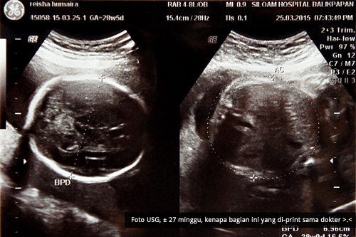 USG 4 DIMENSI: Lengkap Tentang USG 2 Dimensi, 3 Dimensi dan 4 Dimensi