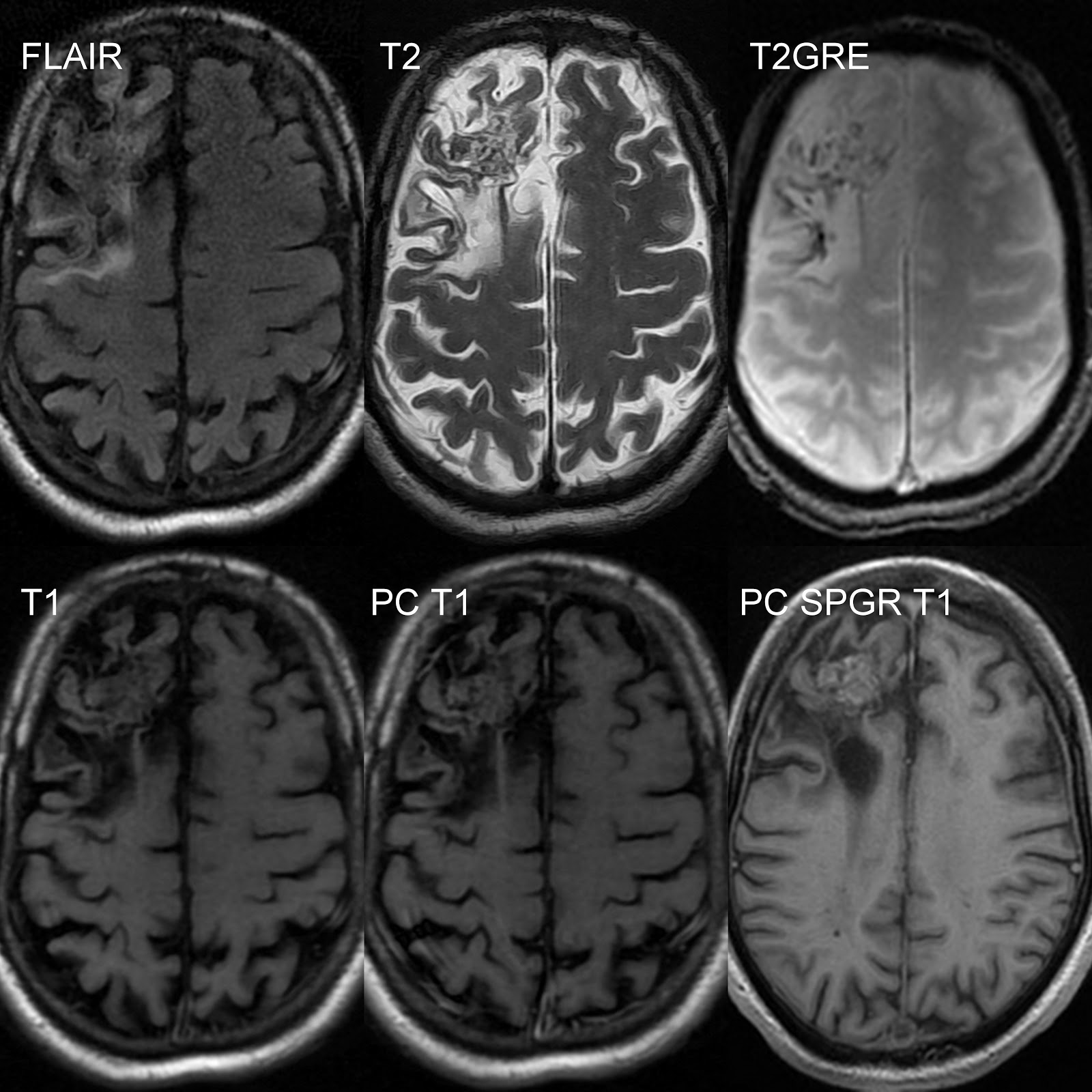 Dr Balaji Anvekar FRCR: Cavernoma with Bleed