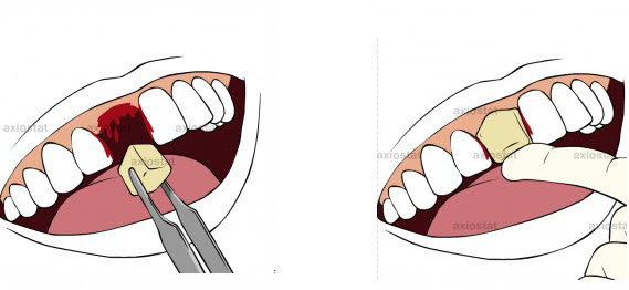 Axio Biosolutions Private Limited: Control Oral Bleeding Through ...