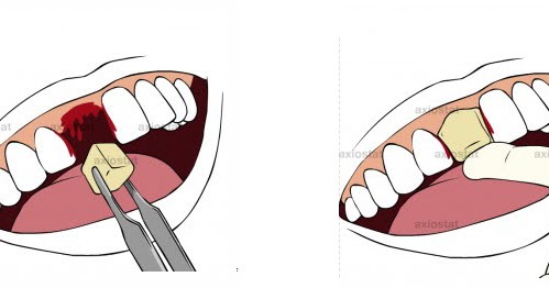 Axio Biosolutions Private Limited: Control Oral Bleeding Through ...