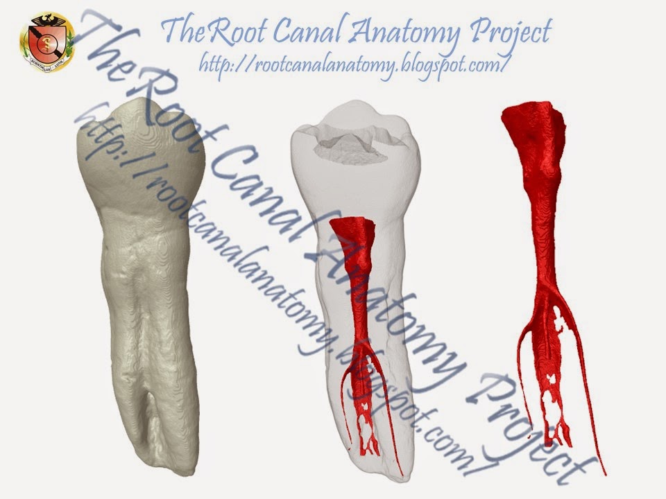 The Root Canal Anatomy Project: C-Shaped Mandibular First Premolar