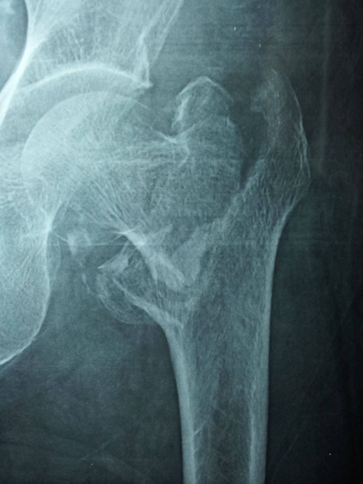 ORTHO ONE ORTHOPEDIC: MINIMALLY INVASIVE HIP FRACTURE SURGERY USING ...