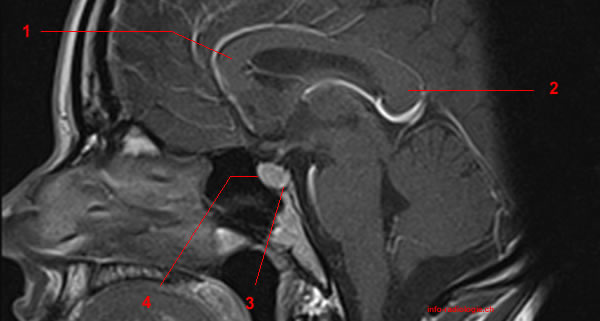 INRA: Sindrome de la silla turca y la importancia de la RMN