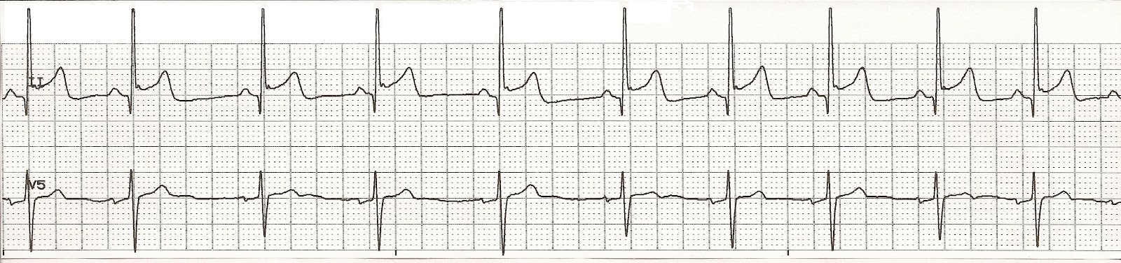 EKG Rhythm Strips 62