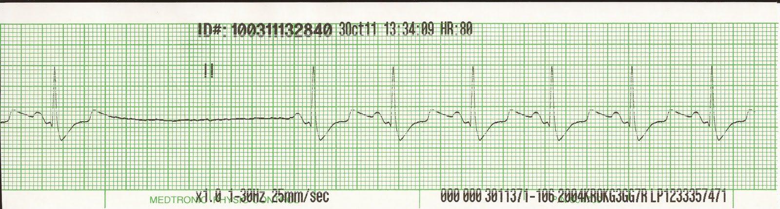 Pediatric Advance Life Support: Unstable Bradycardia