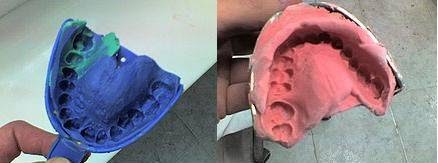PROTESIS DENTAL : IMPRESIÓN DENTAL : cubetas, clasificación,tipos de ...