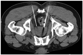 Prostate biopsy ( transrectal US-guided and Transgluteal CT-guided ...