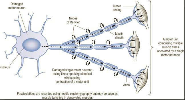 Living with Kennedy's Disease: Mouth and tongue fasciculations in ...