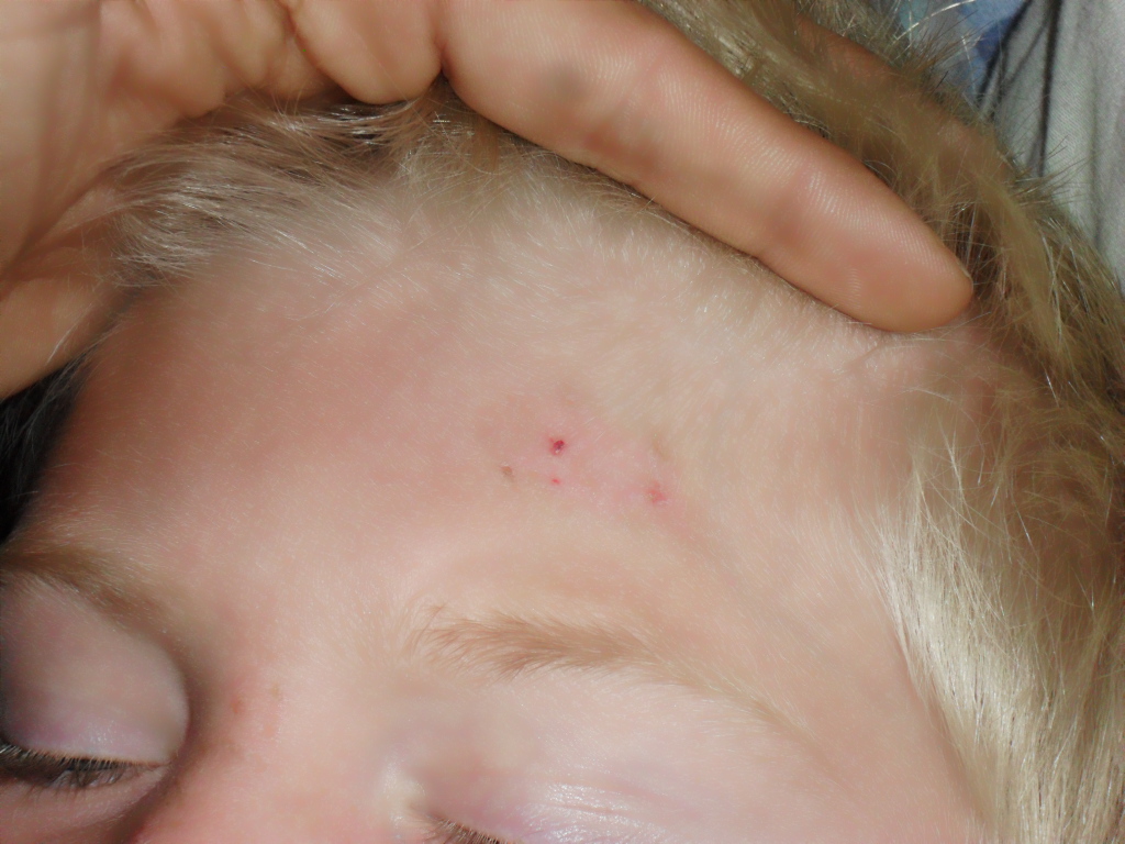 Road Rash.......and The Prickly Pear