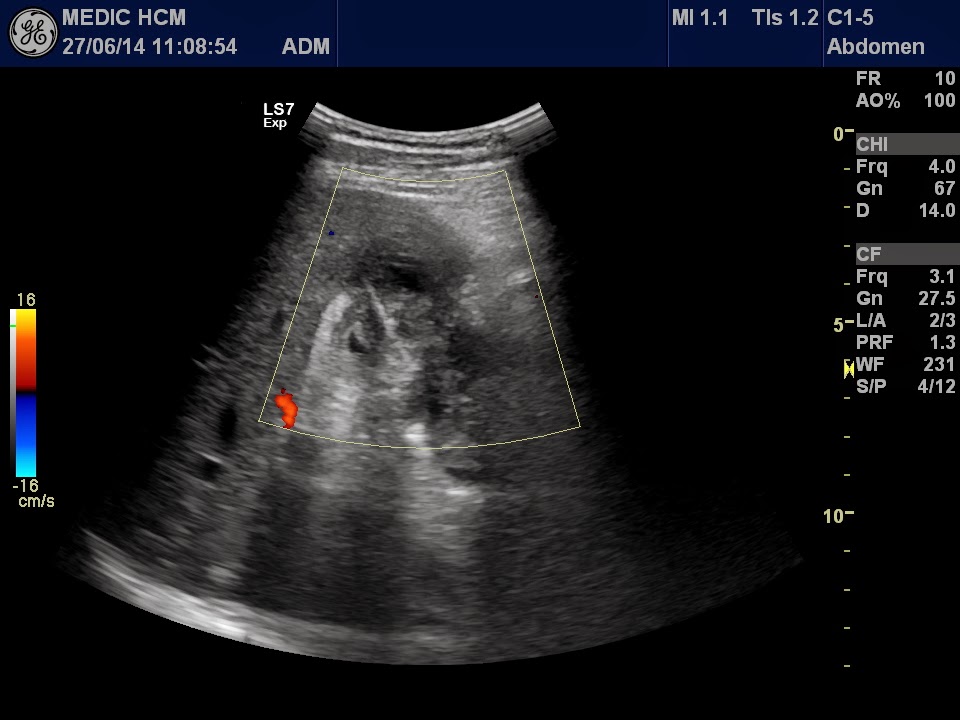 VIETNAMESE MEDIC ULTRASOUND: CASE 265: FISH BONE IN GALLBLADDER: Dr ...