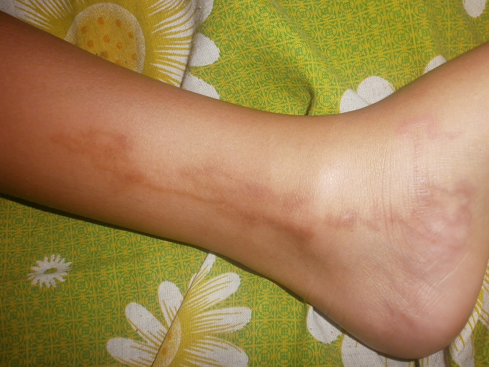 CUTANEOUS LARVA MIGRANS ~ Survailans Puskesmas Parungpanjang