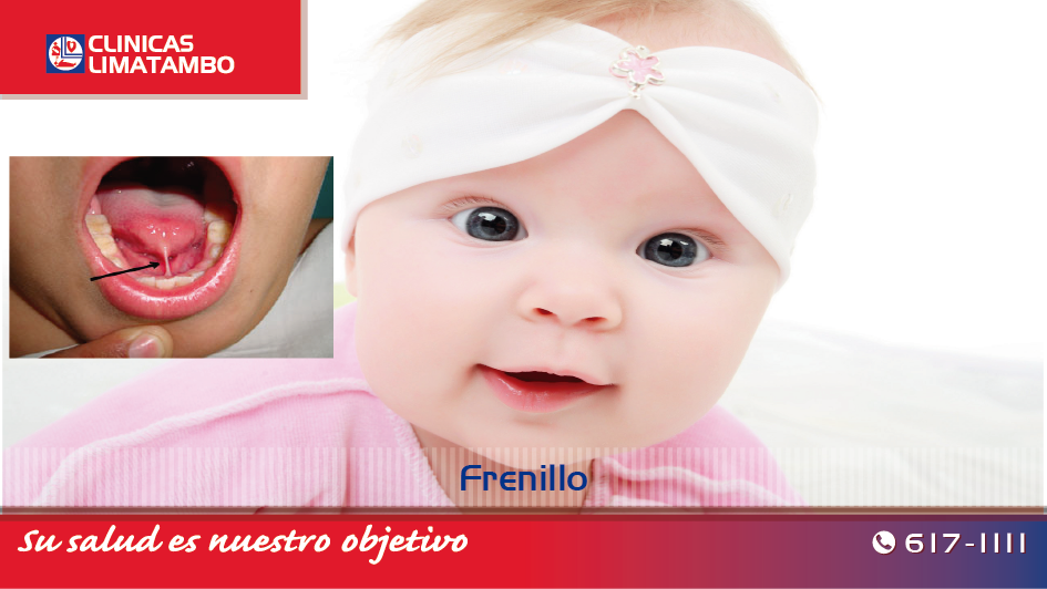 Frenillo ~ Clinica Limatambo