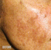 SkinStation: NEW LASER TREATMENT OF MELASMA