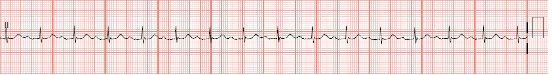 Basic ECG Rhythms