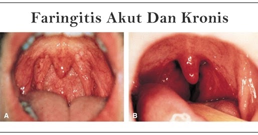 TipsInfoBelajar: ASUHAN KEPERAWATAN PADA KASUS FARINGITIS