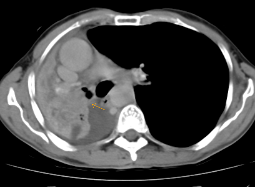 Bronchial Cut Off-CXR - Sumer's Radiology Blog