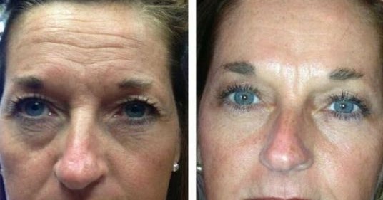 Natural Oriental Facelift By Applying Face Exercises The Chinese Acupressure Facelift Meets
