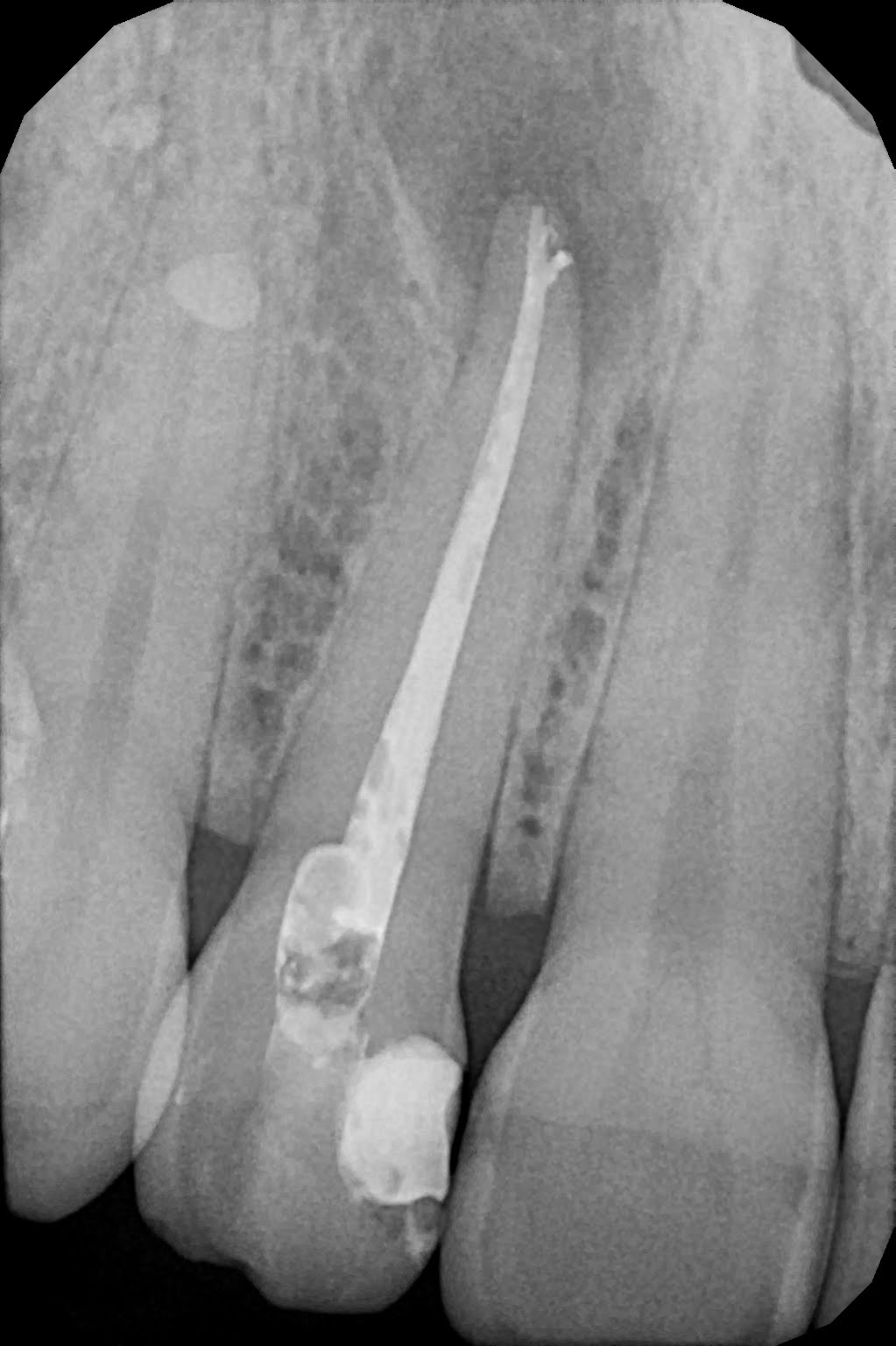 endodonciamississippi: Revision de 3 meses de una infección apical en ...