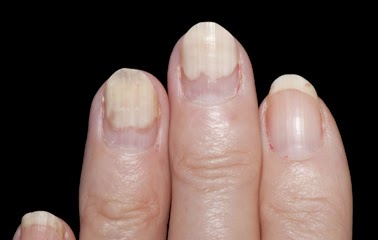 2) Colour of the nails:-