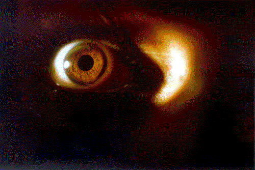 Images For Kayser Fleischer (KF) Ring - Wilson's Disease ~ YOUNG ...