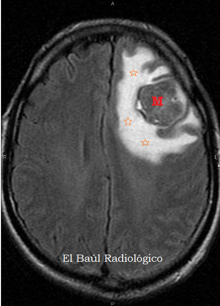 El Baúl Radiológico: 1) EDEMA VASOGÉNICO EN EL SISTEMA NERVIOSO CENTRAL ...