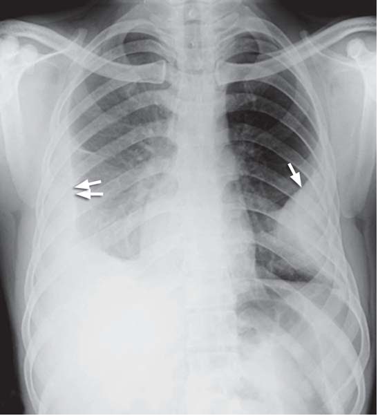 Study Medical Photos: A Case Of Encysted Pleural Effusion