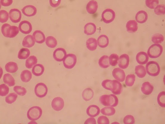 HEMATOLOGIA: ANULOCITOS