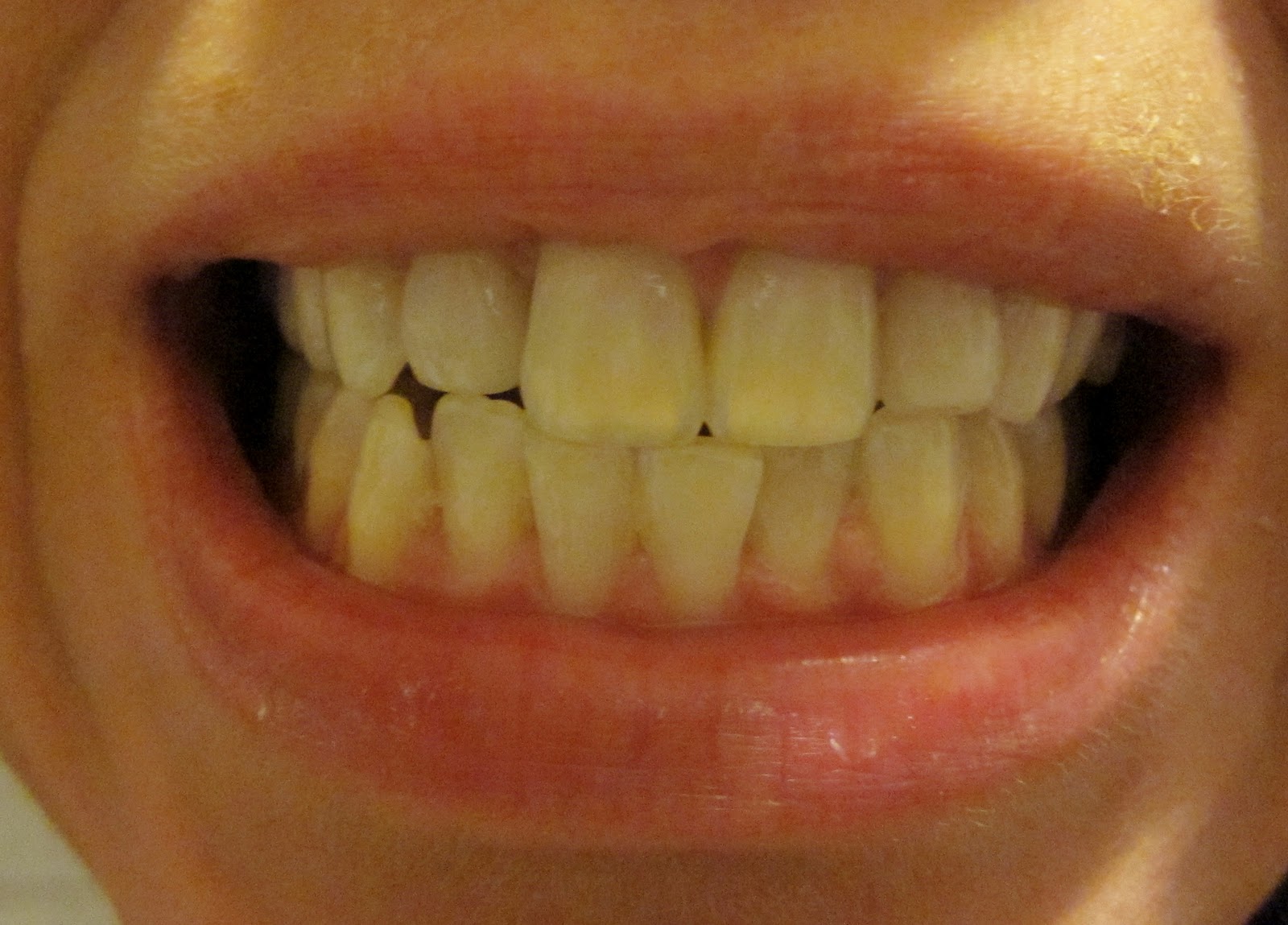 Jessica Jean Myers: Whitening Lightning - Tooth Whitening Review