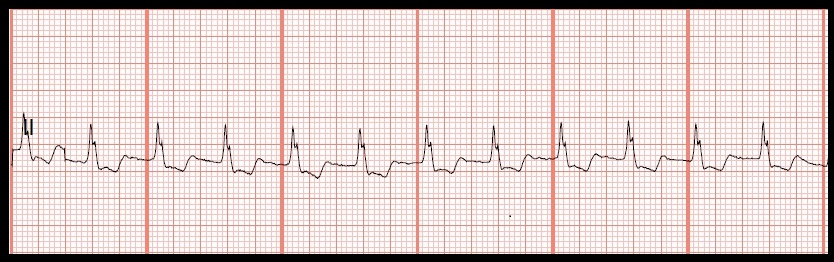 Float Nurse: Practice EKG Rhythm Strips 183