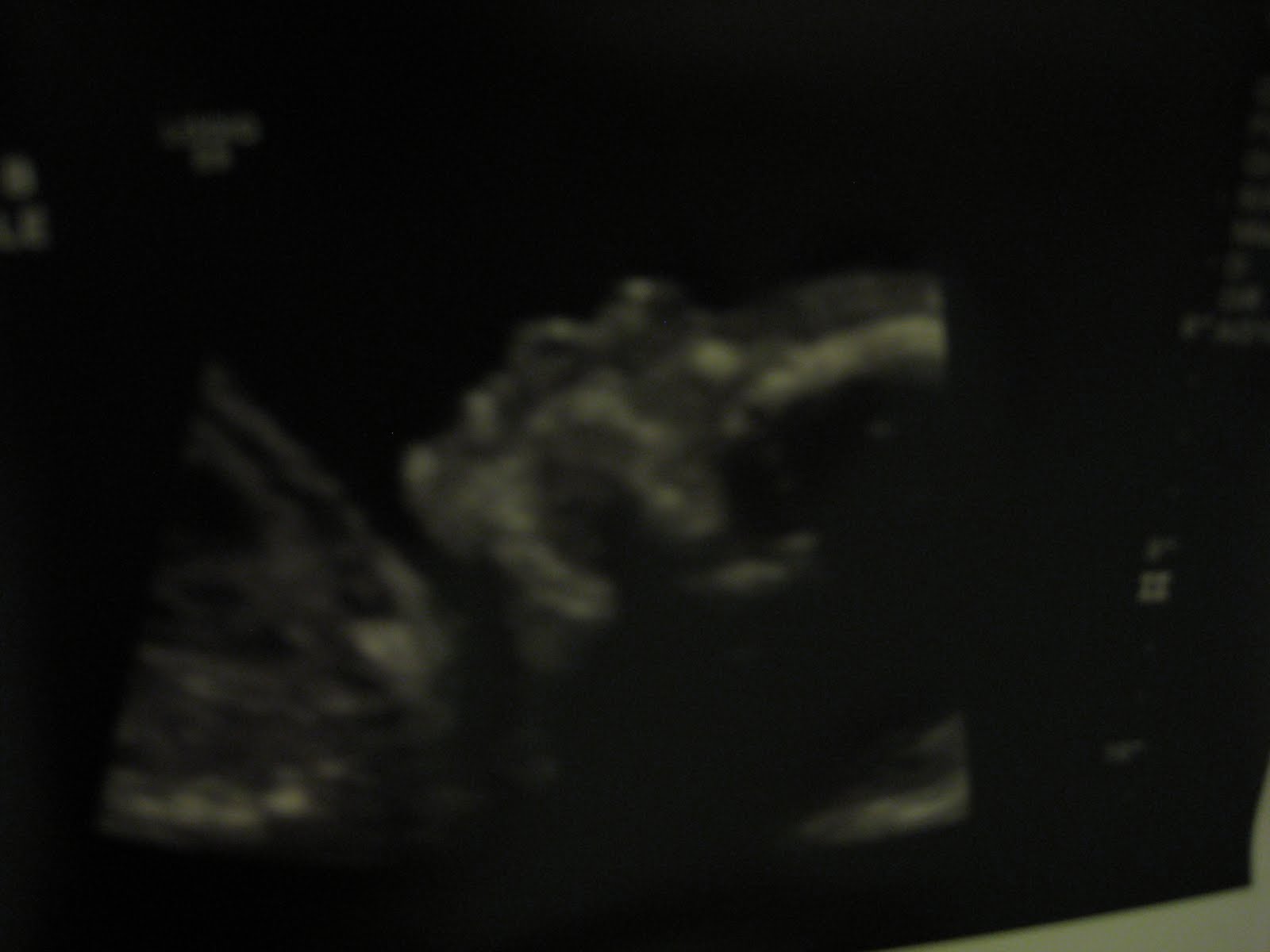 Adventures in Infertility: 19 week anatomy scan