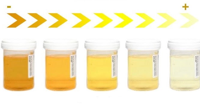 É MUITO IMPORTANTE analise a cor da urina de vez em quando! Pode salvar ...