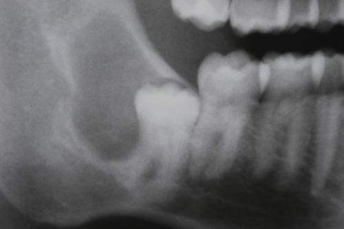 FAMILY CARE DENTAL: WISDOM TEETH