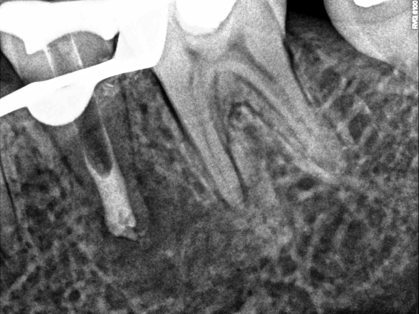 Ask DrM: Peri-radicular healing