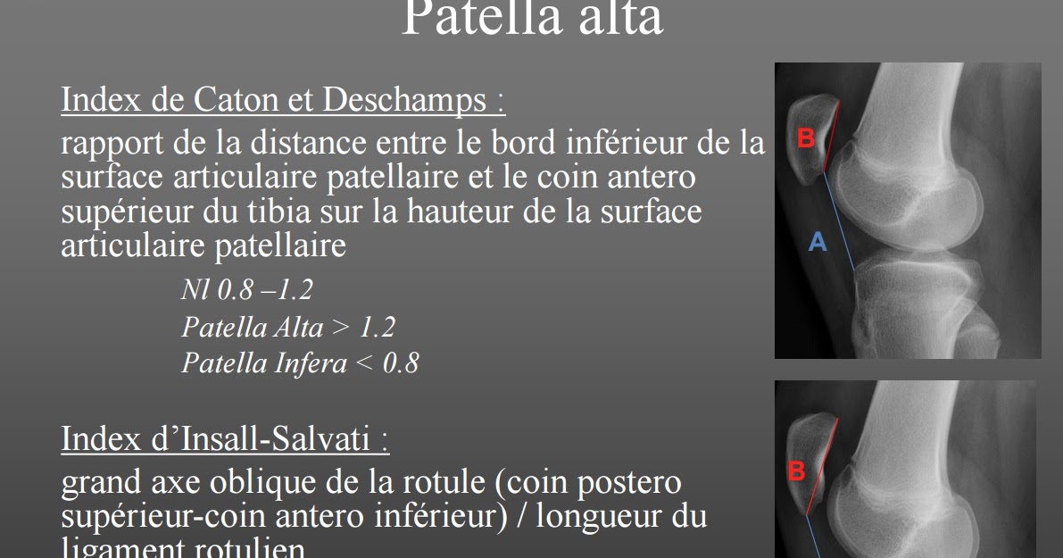 Ma bibliothèque en Imagerie Médicale: PATELLA ALTA