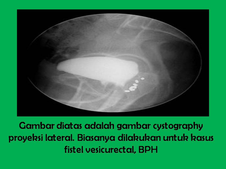 DERAMA: RETROGRADE CYSTOGRAPHY ( CYSTOGRAM)