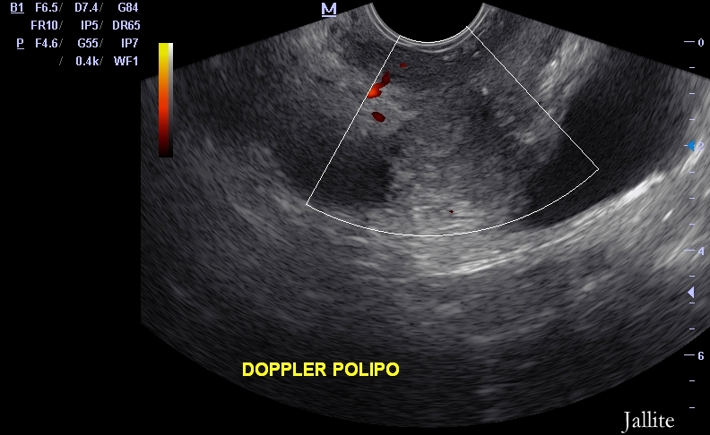 Pólipo Vs Endometrioma Vesical