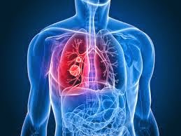 Causes de bronchite - Articles à propos de la santé