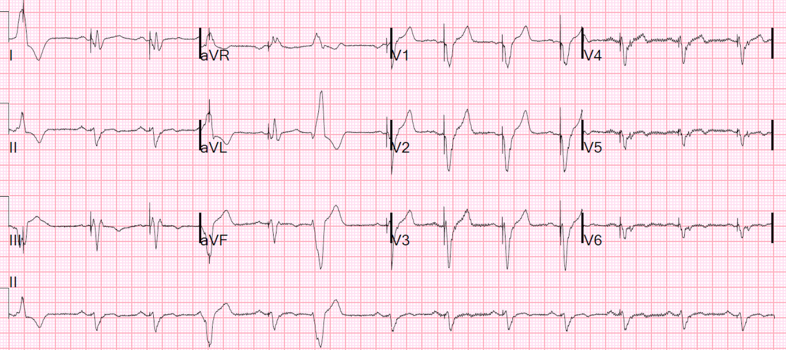 Dr. Smith's ECG Blog: Wide complex tachycardia and an ICD that is not ...