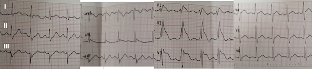 Dr. Smith's ECG Blog: A Middle-Aged male with Chest Pain and an Unusual ECG