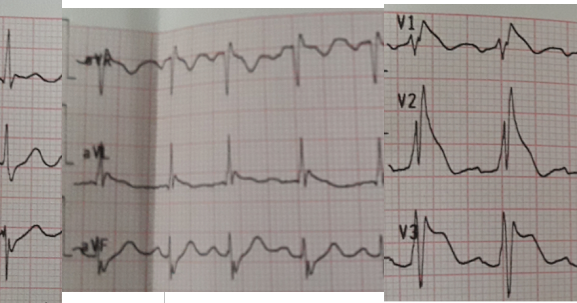 Dr. Smith's ECG Blog: A Middle-Aged male with Chest Pain and an Unusual ECG