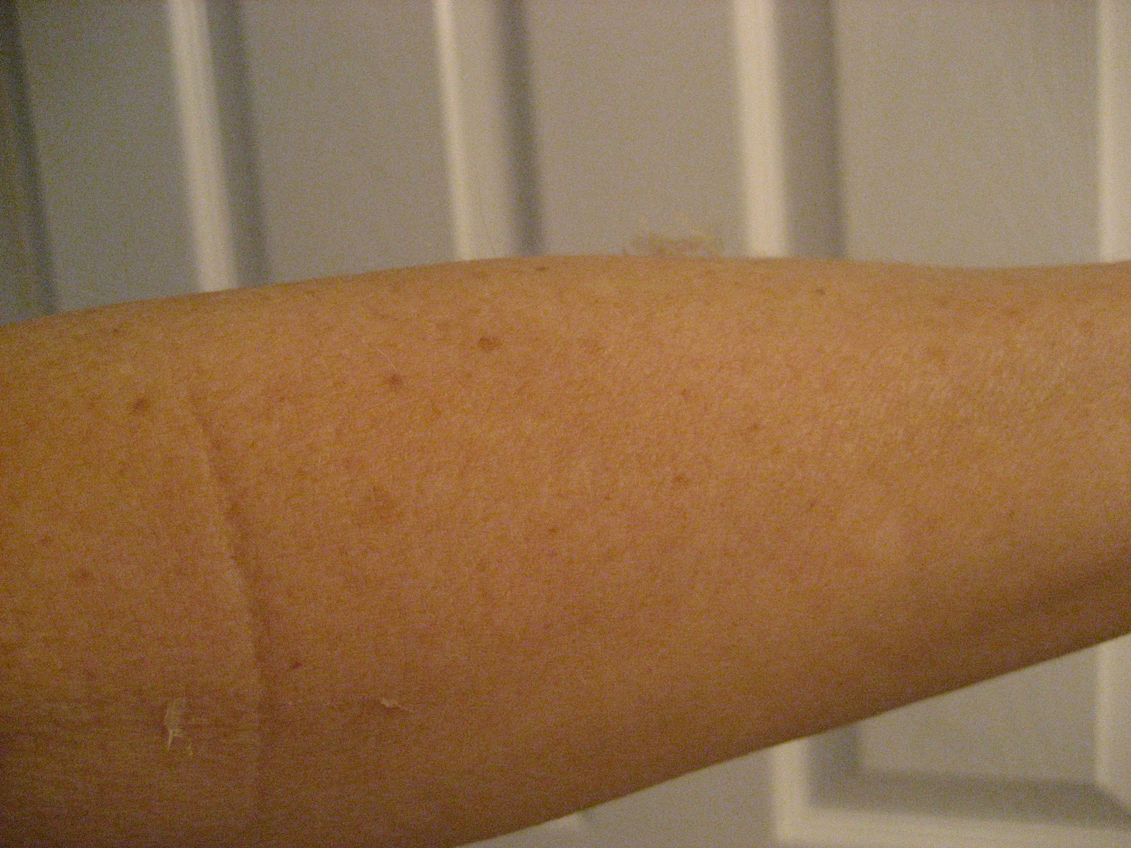Chemical Peels For Acne And Anti Aging 25 Tca Peel For Arms 22 Days To Finish