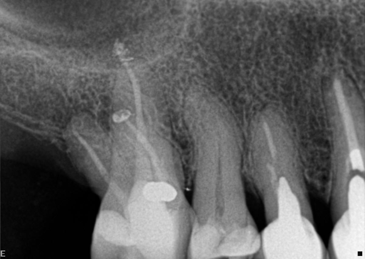 Patrick Baltieri: Tratamento Endodôntico Dente 16 - CANAIS CLASSE III