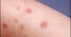 Ayurvedic Treatment of Prurigo Nodularis - Dr. Vikram's Blog ...