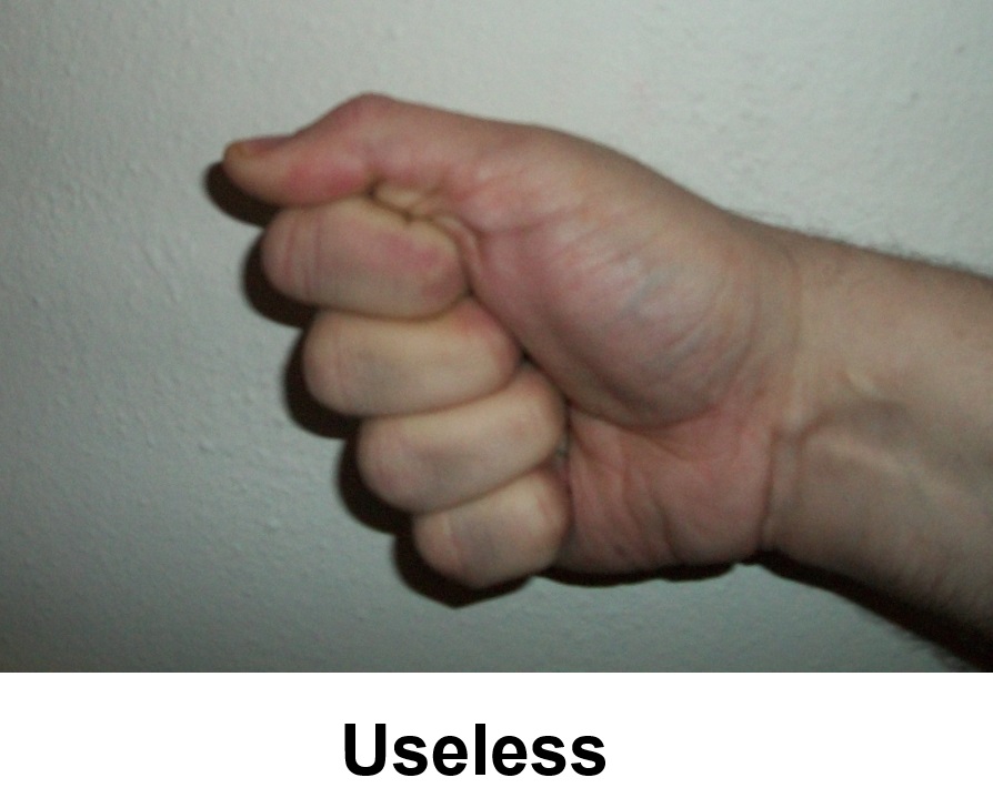 Ryukyu Martial Arts: Small Surface Strikes & Structural Support