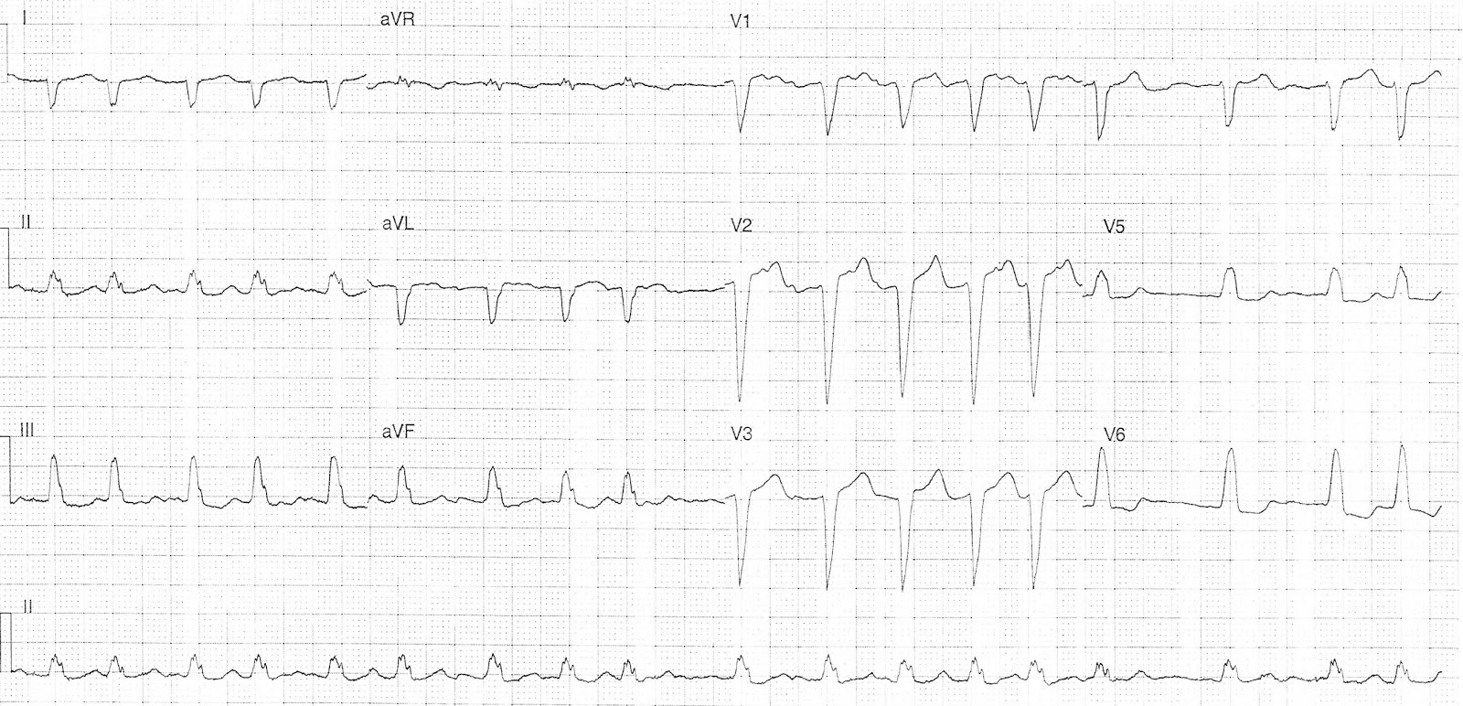 ECG of the Week: ECG of the Week - 4th January 2016 - Interpretation