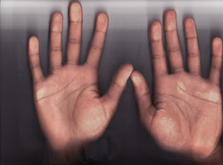 Hand Of Cerebral Palsy Patients Palmistry ~ INDIAN PALM READING | HAST ...