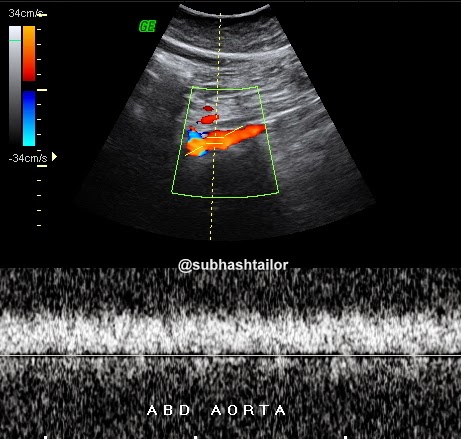 SONO DIGEST: COARCTATION OF AORTA DIAGNOSED BY RENAL DOPPLER