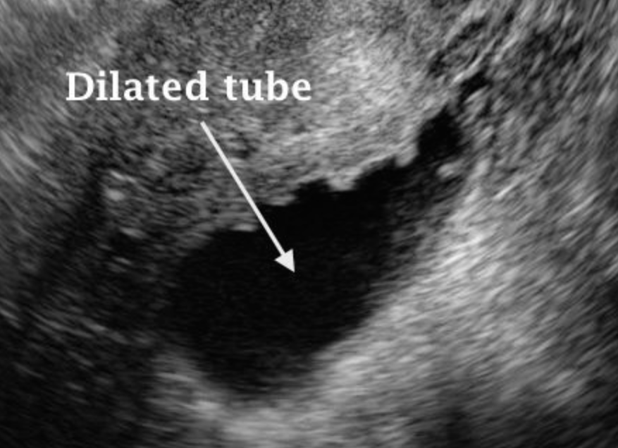 Pelvic Inflammatory Disease and Tubo-Ovarian Abscess
