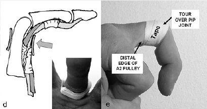 Tom's Physiotherapy Blog: Pulley Injuries: updated