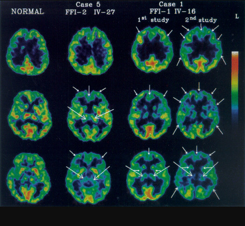 Fatal Familial Insomnia